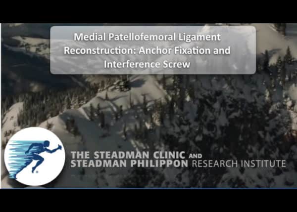 Medial Patellofemoral Ligament Reconstruction in a Revision Setting ...