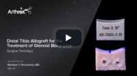Distal Tibia Allograft for the Treatment of Glenoid Bone Loss - Matthew ...